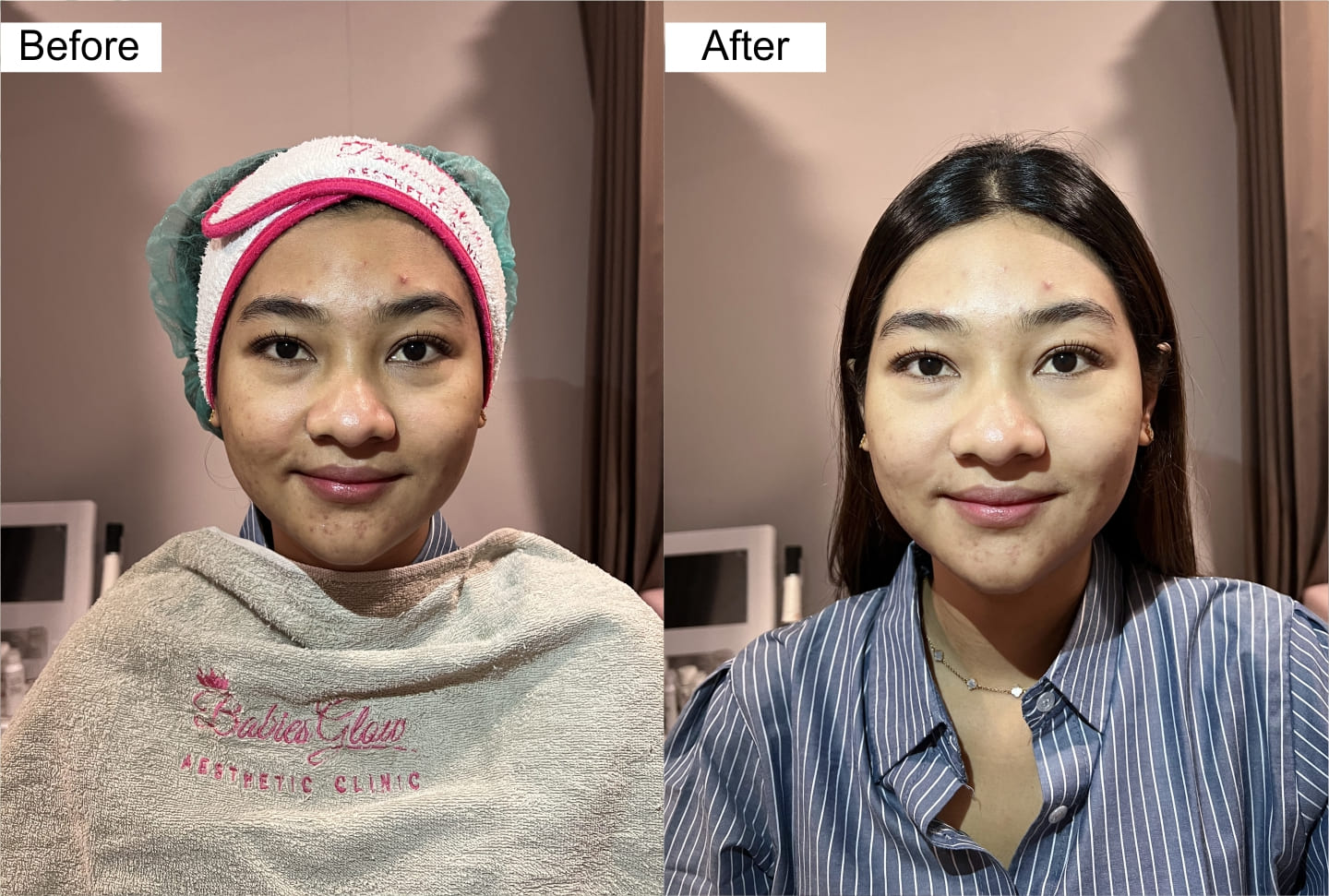 Excellent complexion glow acne facial Klinik Cabang Semarang - Babies ...